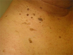 Skin Tags Groin Area